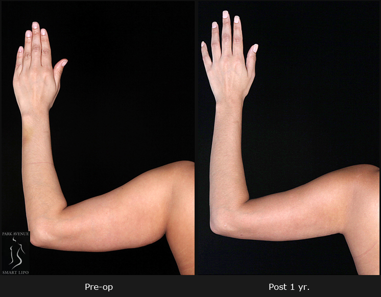 Female Arm Liposuction Before After Photos | Liposuction