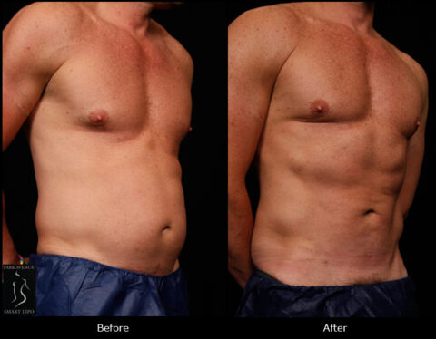 Procedures | Liposuction NYC | Park Avenue Smart Lipo