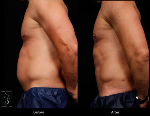 Sculpt Your Body with Smartlipo Laser Liposuction in NYC