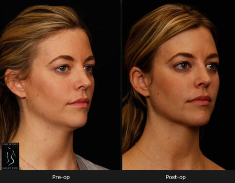 New York City Liposuction | SmartLipo Laser Liposuction NYC