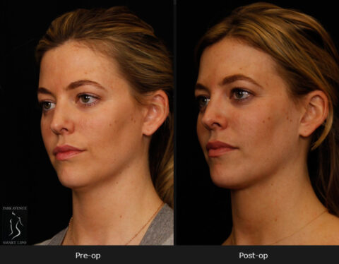 Some Questions about Hi Def liposuction in NYC